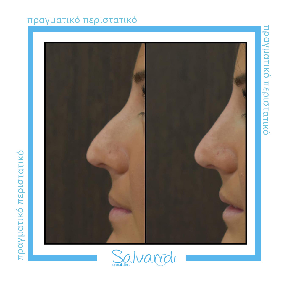 Περιστατικά μη χειρουργικών επεμβάσεων Prime Smile Dental